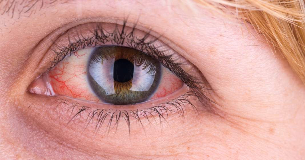 Red Eyes or Bloodshot Eye – Treatment, Causes, Best Eye Drops