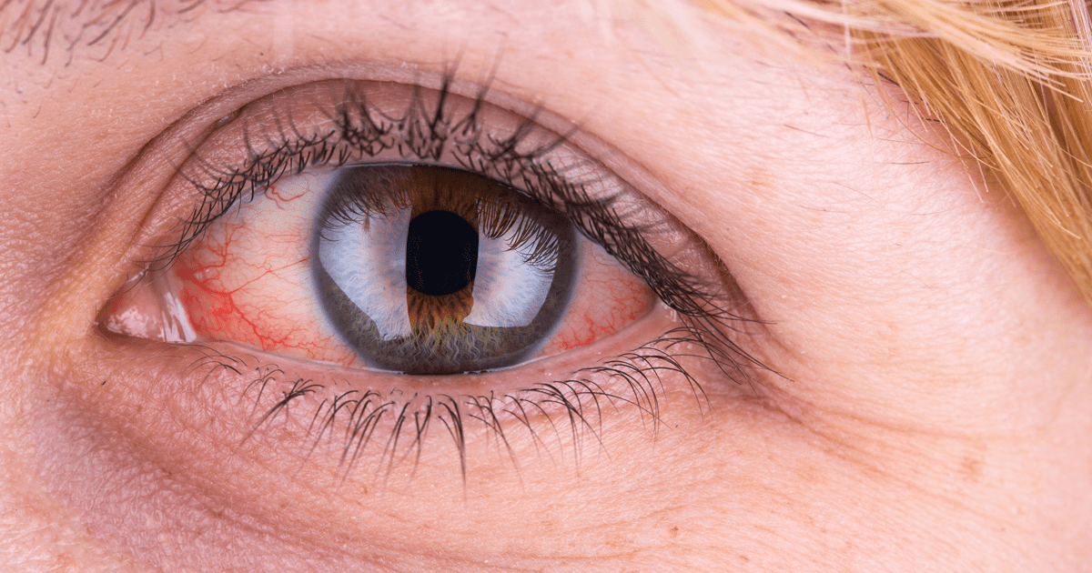 Red Eyes or Bloodshot Eye – Treatment, Causes, Best Eye Drops