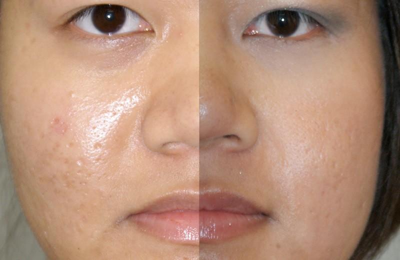 Top 5 Best Open Pores Remedies to Shrink Pores Naturally