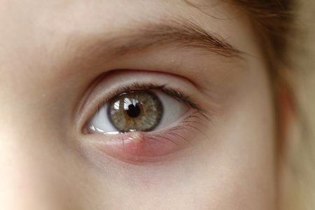 Eyelid Bumps or Blisters on Eyelid| Types, Causes, Symptoms & Treatment