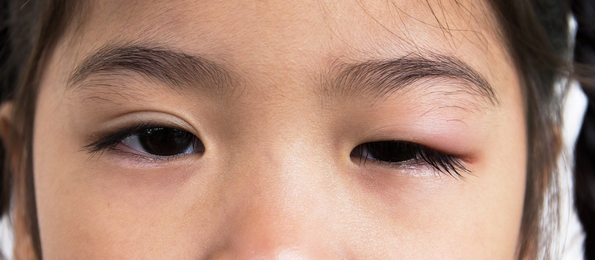Home Remedies For Swollen Eyes and Symptoms Causes | Luster Eyes