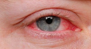 How long does Pink Eye Last | Intro Symptoms Types And Prevention