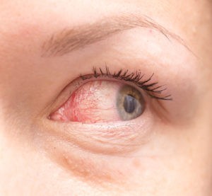 Kinds of eye infections symptoms complications and ways to prevent them