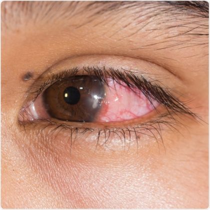 Common Eye Infections: Causes And Symptoms I Lustereyes